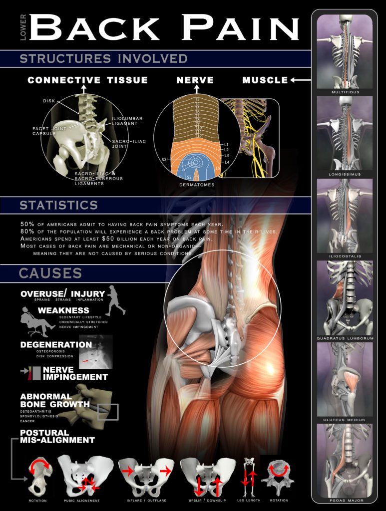 Lower Back Pain Why How And Where Infographic Lower Back Pain Why How And Where Infographic